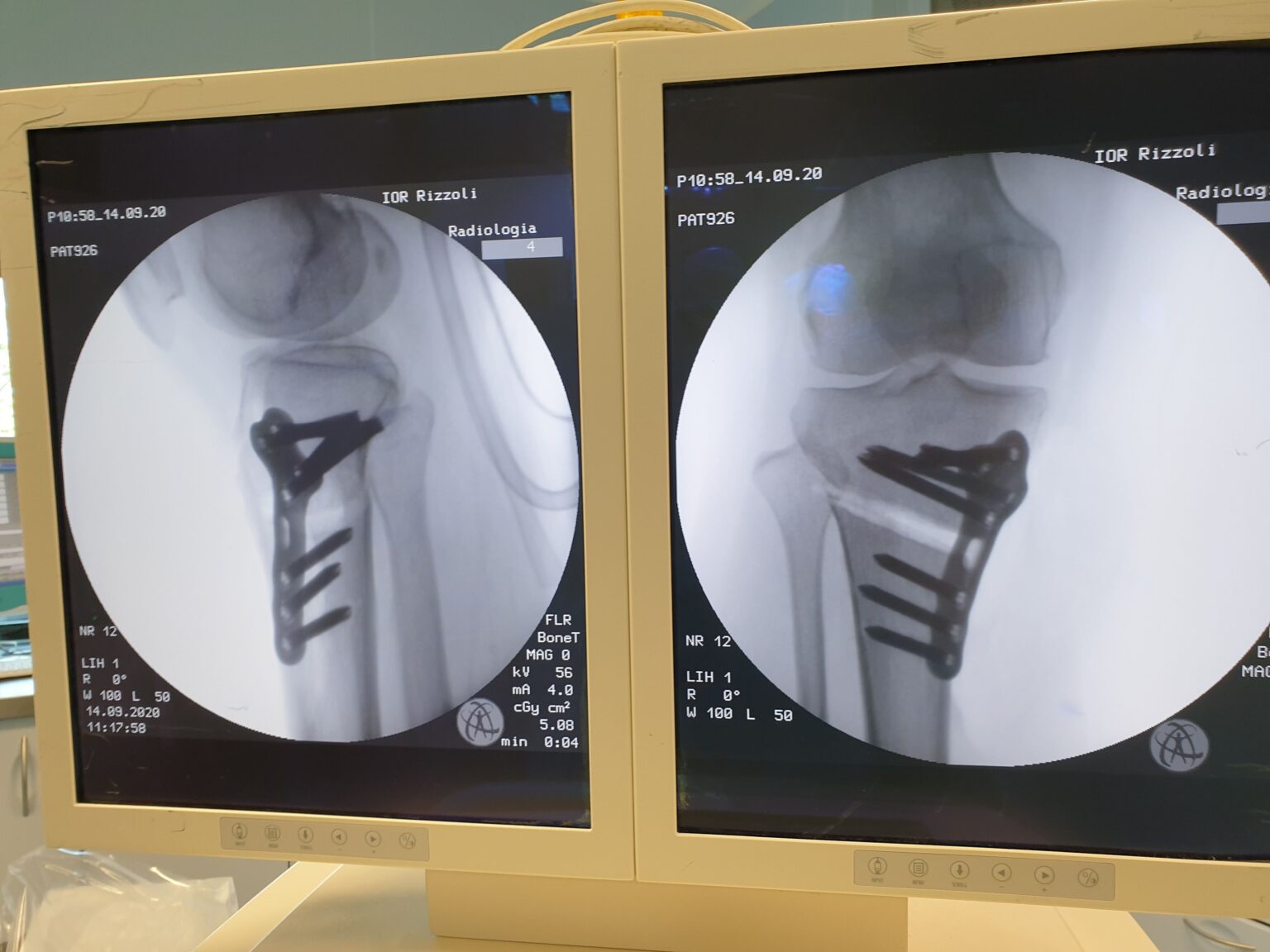Understanding the Benefits and Risks of High Tibial Osteotomy - Orthoscape